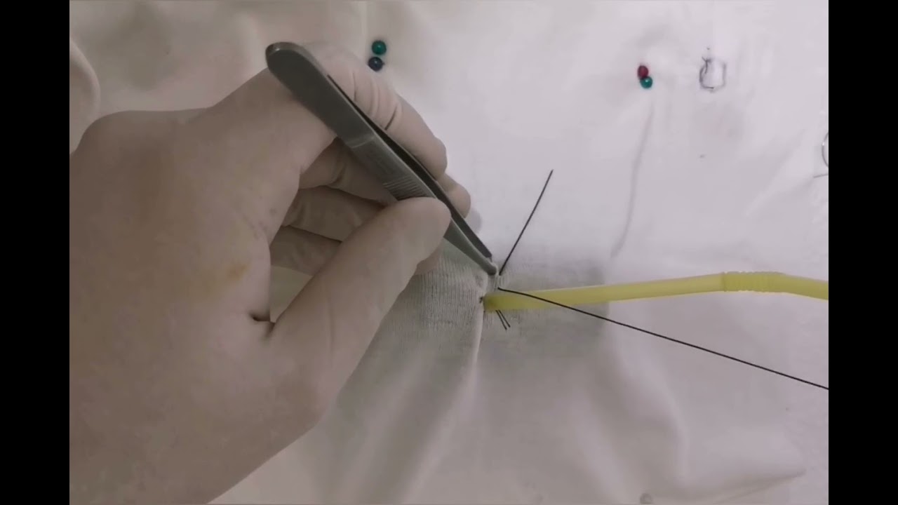 Gastrostomía tipo Stamm y Yeyunostomía tipo Witzel Suasnabar Campos ...