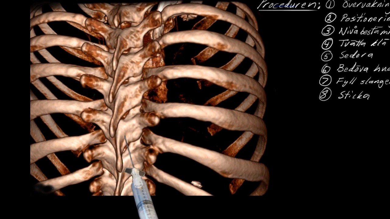 Procedurer Thorakal EDA - YouTube