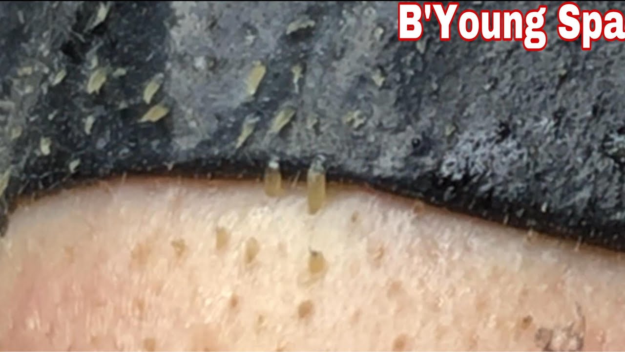 the process of removing many hidden pimples deep inside | wherever it ...