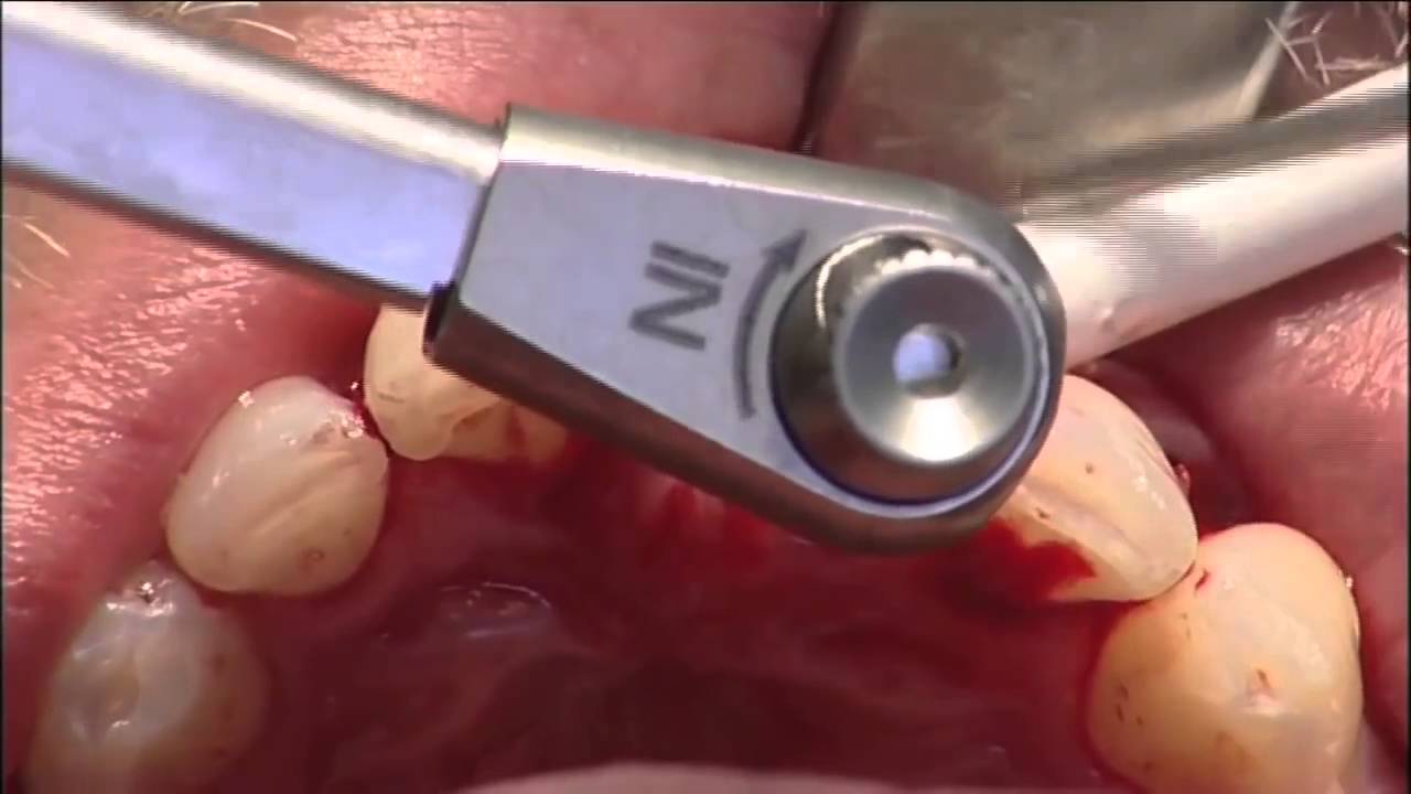 4) ASTRA TECH Implant System - Installation - YouTube