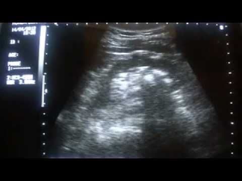 renal calculi lower pole of kidney - YouTube