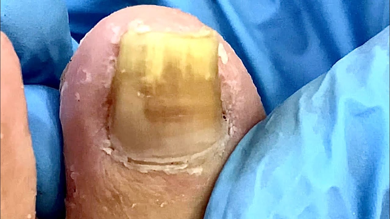 Toenails of the elderly, thick and hard【TD foot care】 - YouTube