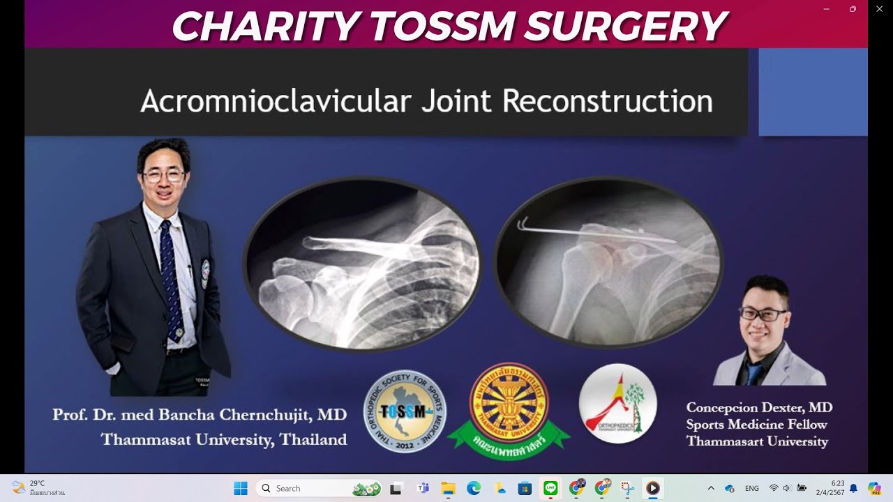Chronic ACJ Dislocation Reconstruction using Hamstring Tendon: TOSSM ...