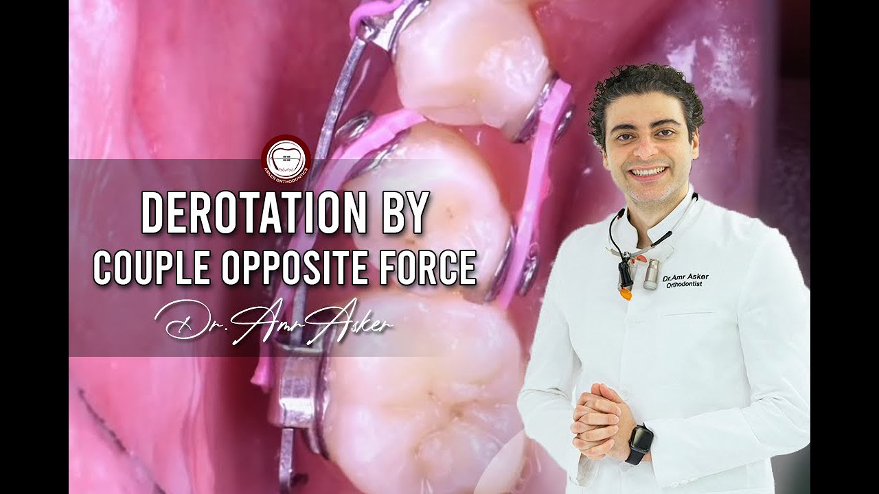 Couple opposite force for tooth de-rotation bucco-lingual mechanics ...