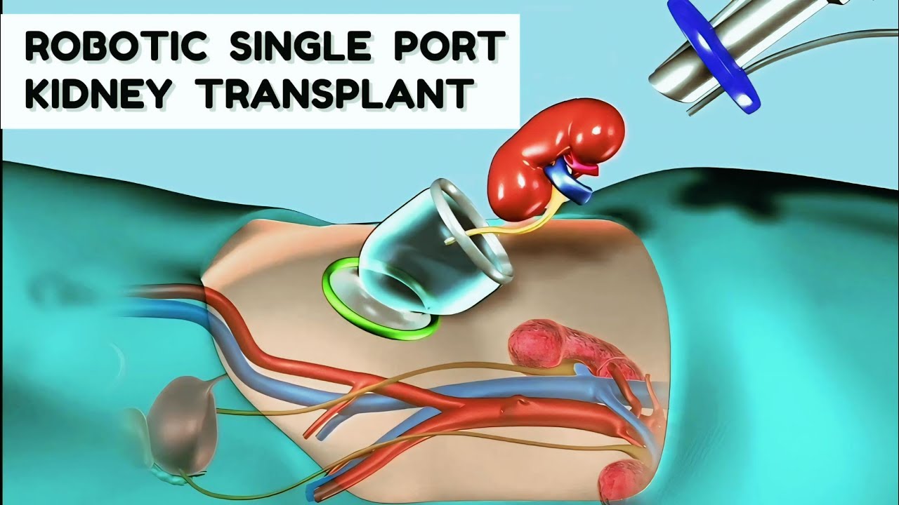 Robotic single port kidney transplant Procedure | Animation - YouTube