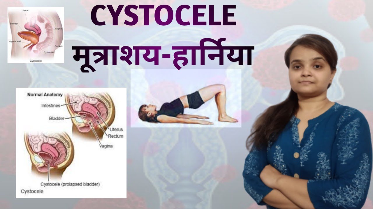 CYSTOCELE (मूत्राशय-हार्निया) - YouTube