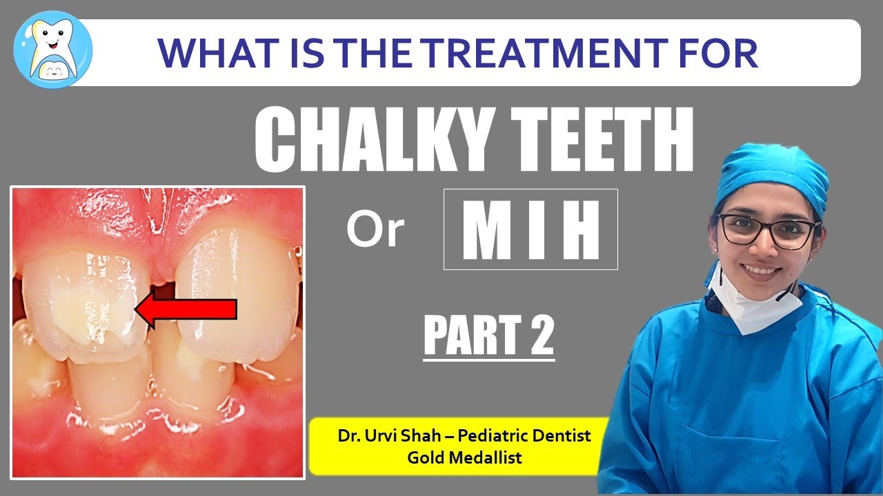 Chalky teeth: Treatment for MIH in front teeth - YouTube