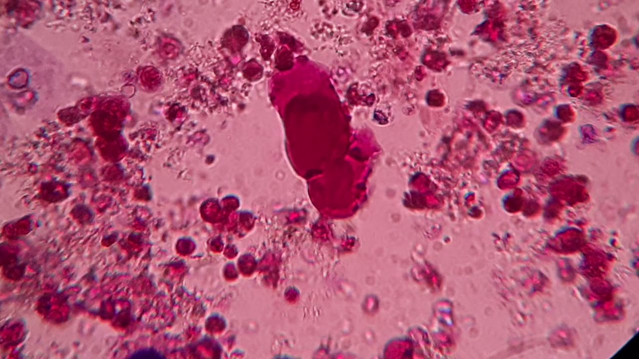 Sediment Urine: Epitel, WbC, RBC, bacteria, Cast, transitional cell ...