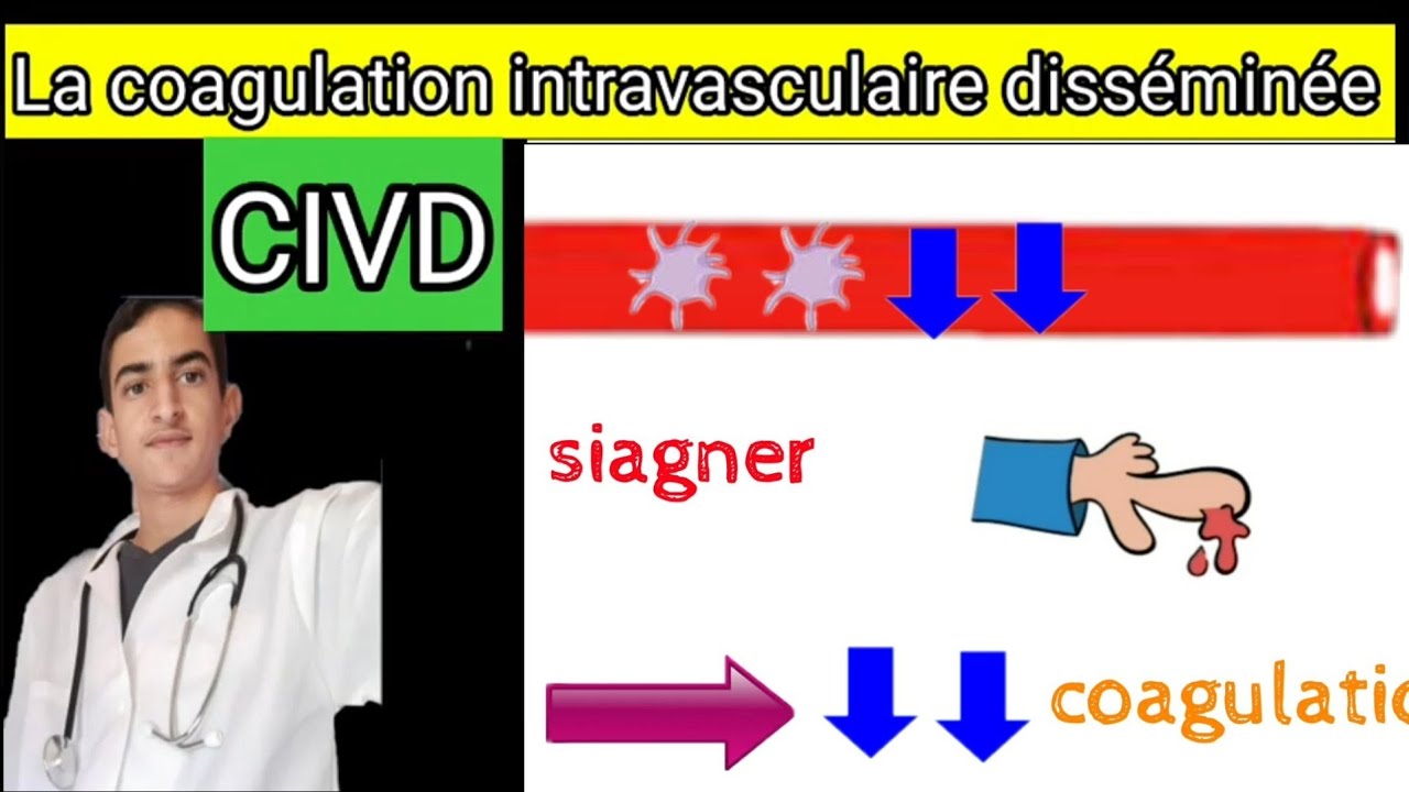 la coagulation intravasculaire disiminée civd - YouTube
