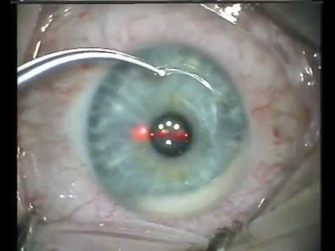 Making the flap by flaporhexis - 2005 Intralase femto-LASER User ...