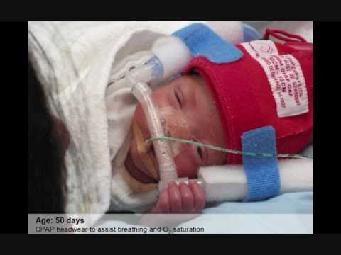 Premature baby girl 23 week gestation - YouTube