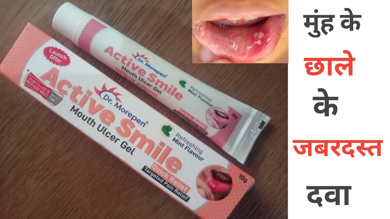 मुंह के छालों के जबरदस्त दवा, Active smile mouth Gel,uses,Dosage, लगाने ...