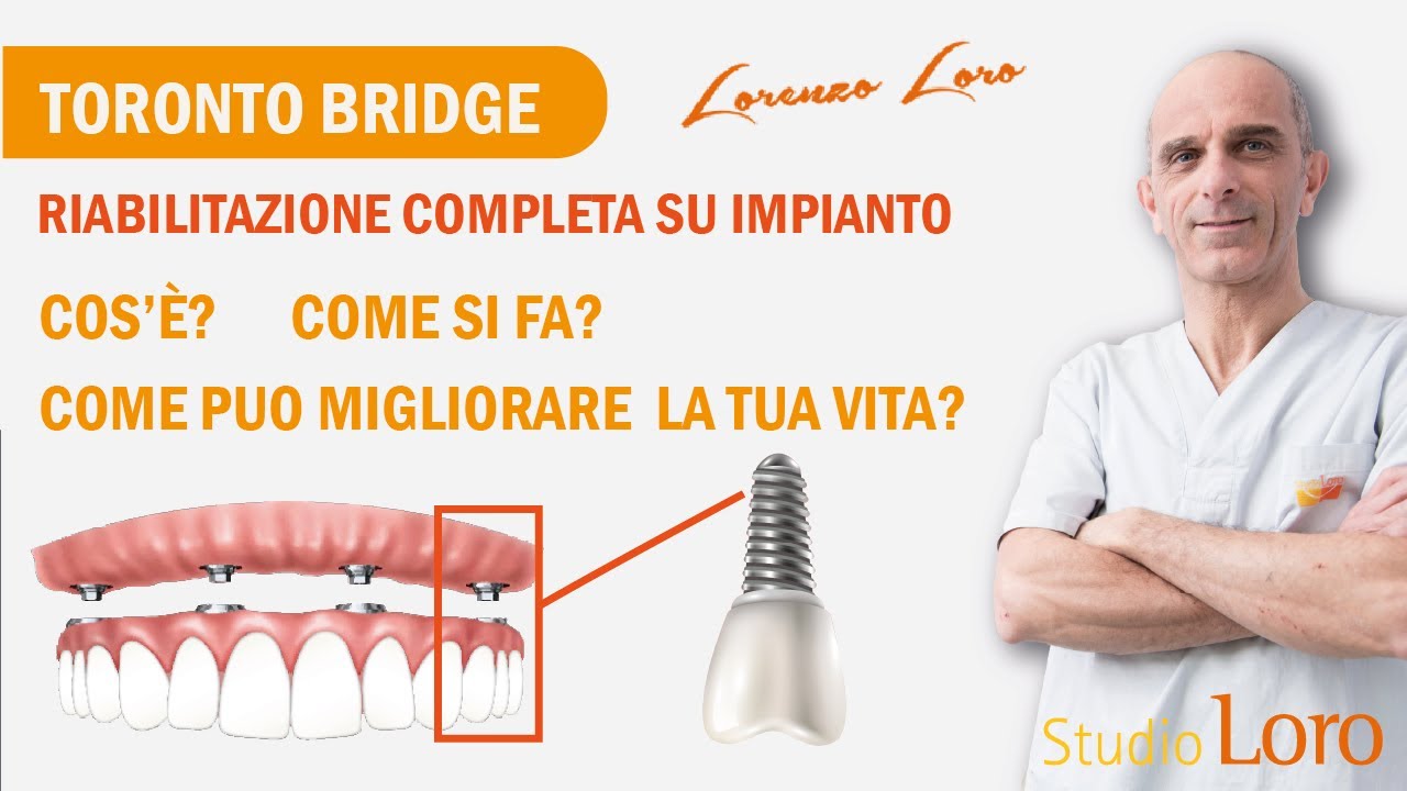 Toronto Bridge: cos'è un impianto dentale? Come si mette? Quali i ...