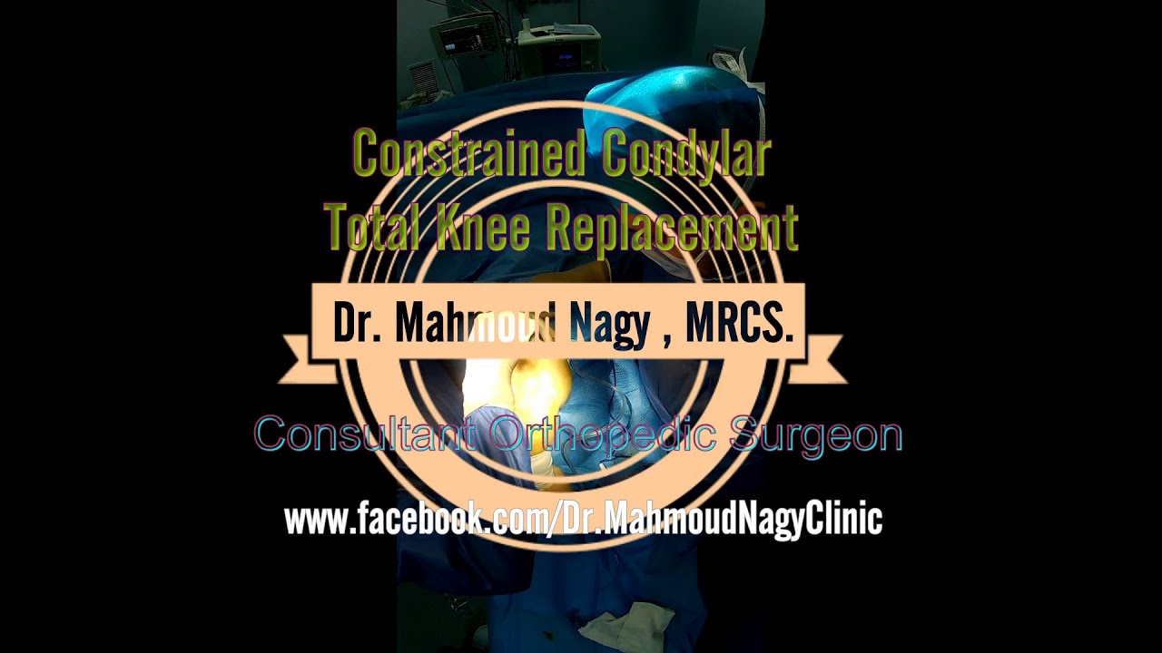 Constrained Condylar Total Knee replacement - YouTube