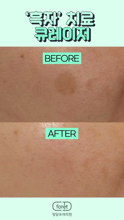 이것만 없어도 젊어보인다 흑자치료 Beforeandafter 흑자 흑자치료 기미잡티 잡티제거 큐레이저 흑자제거 피부과시술추천 흑자전후 흑자레이저 청담포레의원