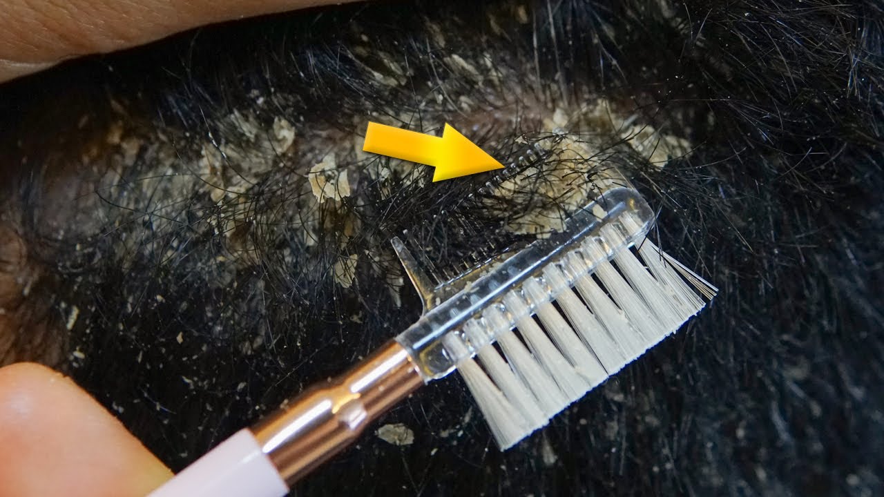 Scalp Scratching Dandruff | Satisfying Scalp Scratch (Huge Flakes ...