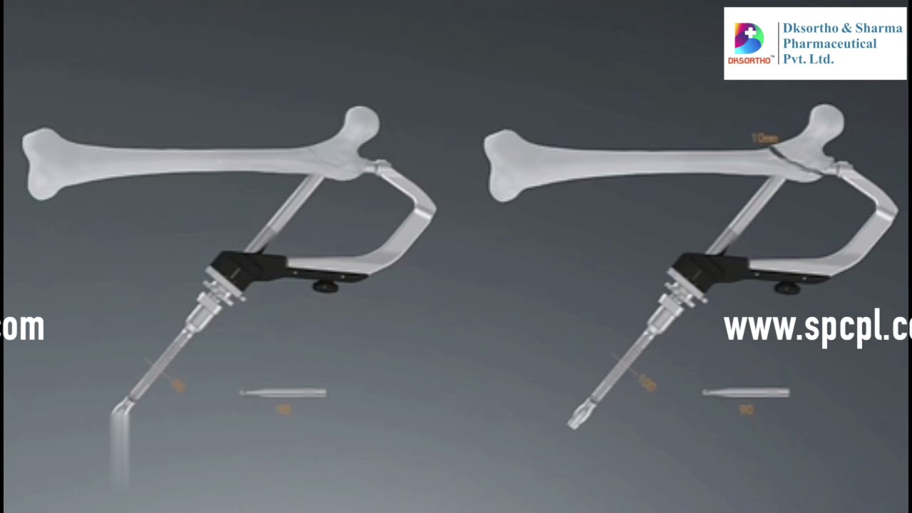 Trochanteric Nailing Surgical Procedure by DKSORTHO & Sharma ...