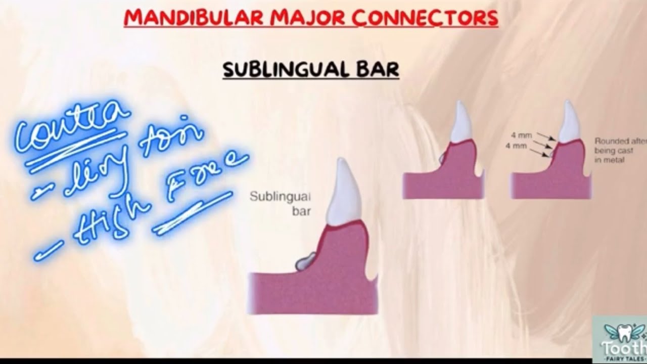 Mandibular Major Connectors : RPD lectures- Cingulum bar, Labial bar ...
