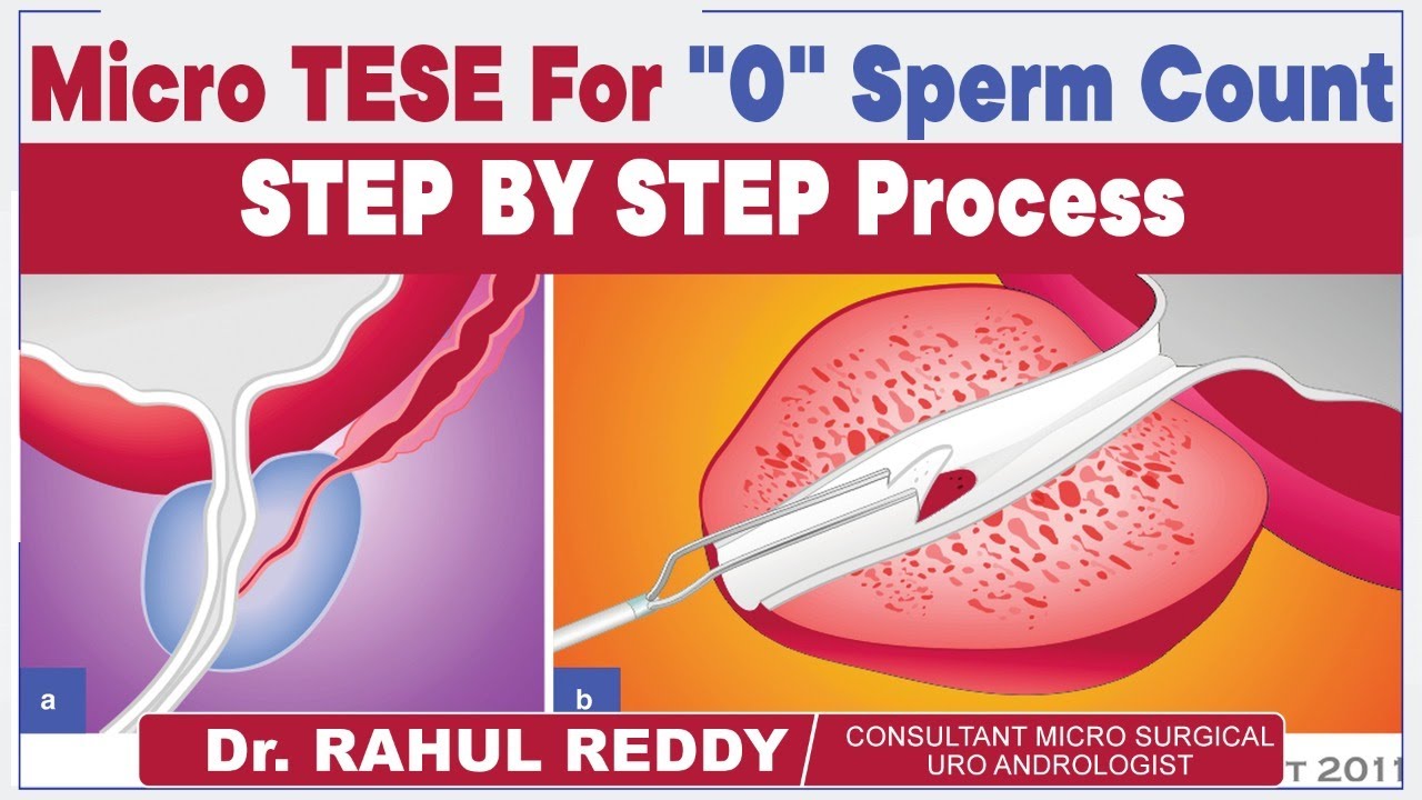 What is Micro TESE? || Surgery Treatment Of Azoospermia || Dr Rahul ...