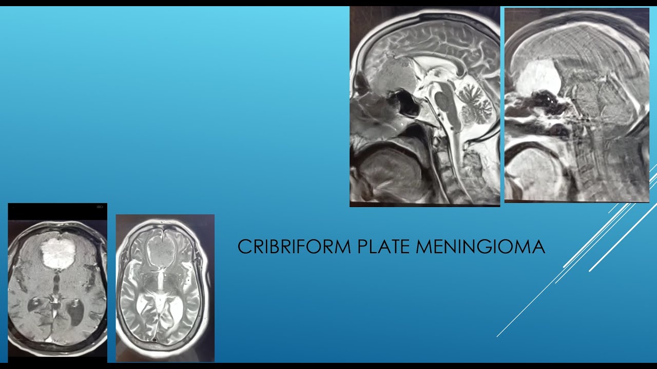 CASE# 4 CRIBRIFORM PLATE (Olfactory groove) MENINGIOMA - YouTube