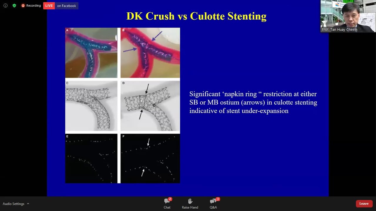 Topic-1: DEB/DCB, Topic-2: LM Bifurcation, Topic-3: DEFINITION II Trial ...