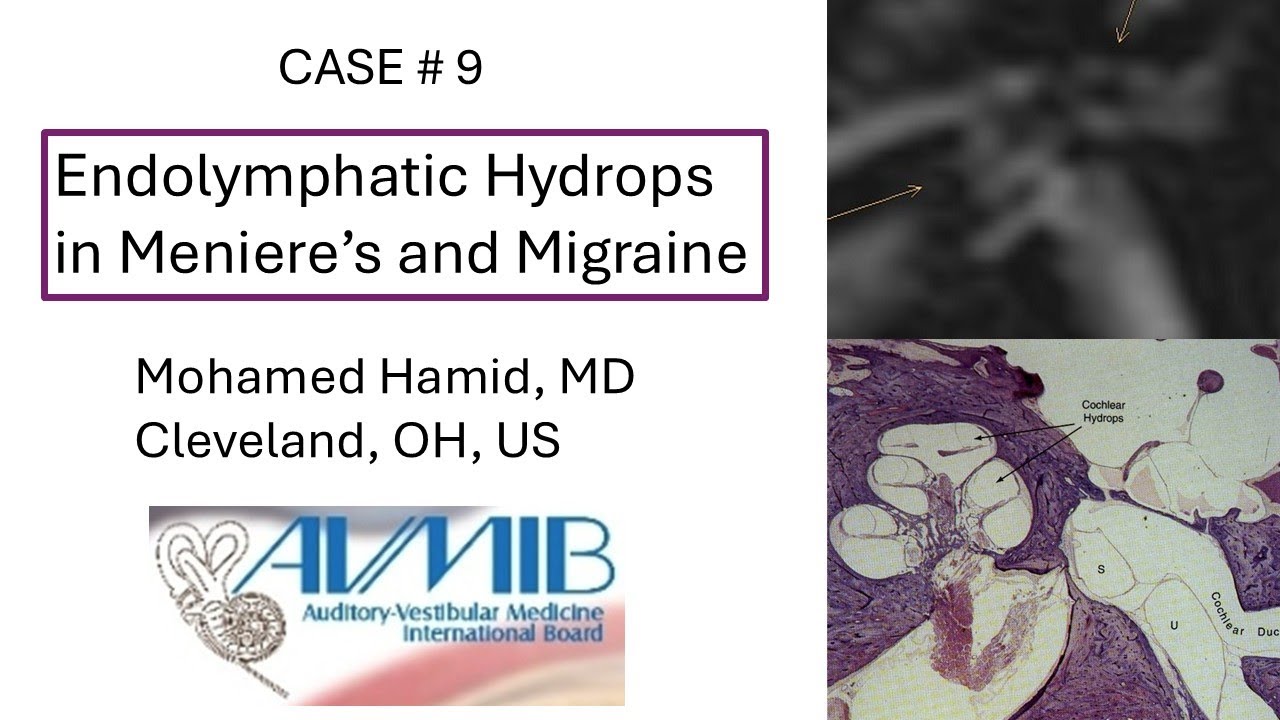 Case 9 Hydrops in Meniere's and Migraine - YouTube