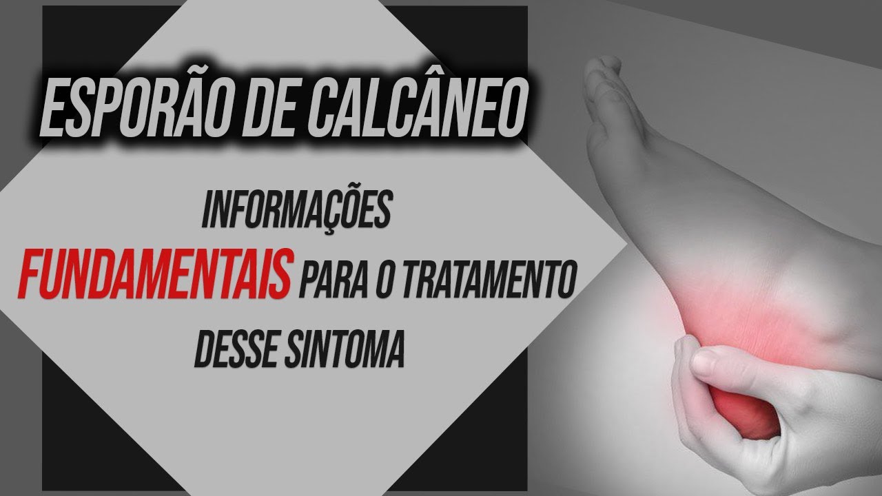 Esporão de calcâneo: Informações que podem ser fundamentais para o ...