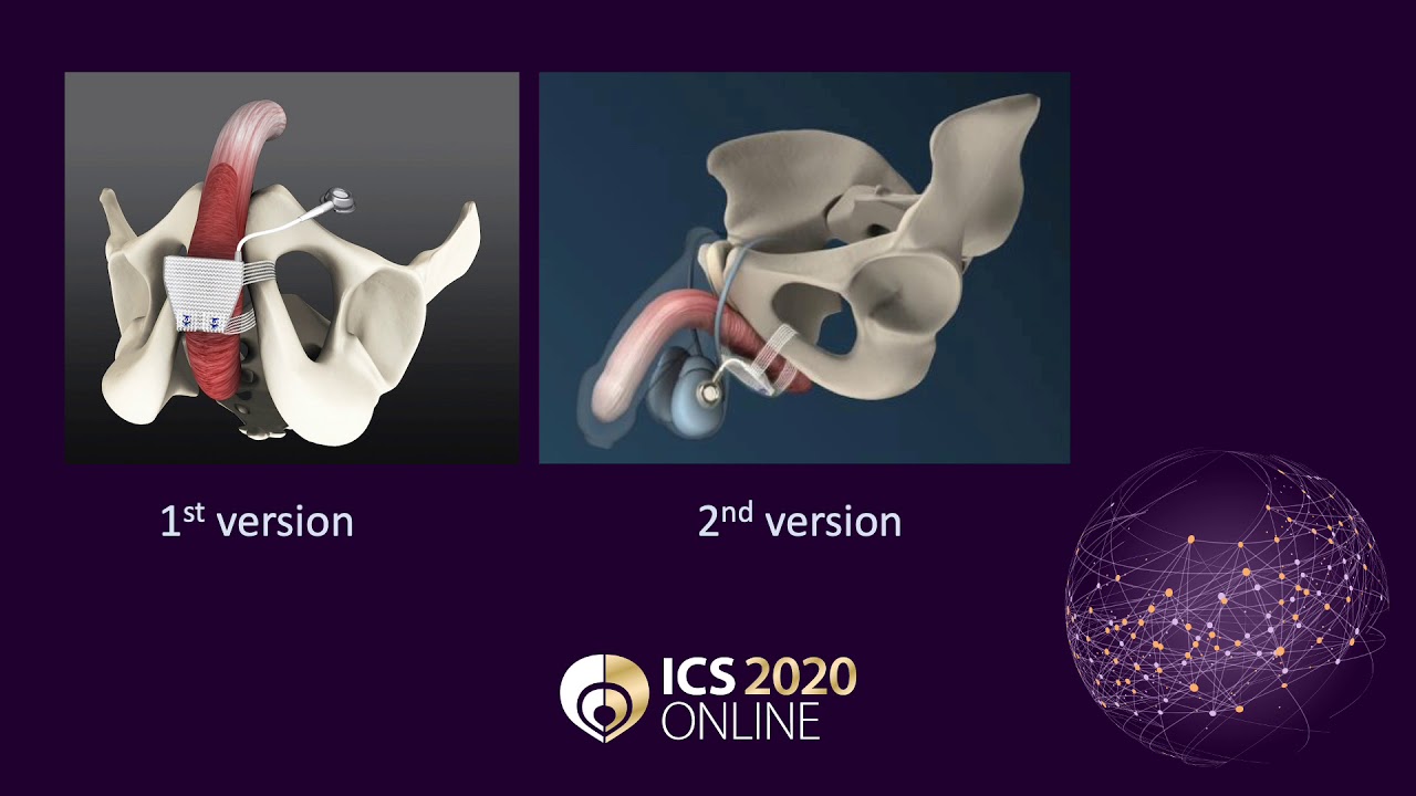 ICS 2020 Abstract #80 Results and early complication rates of the ATOMS ...
