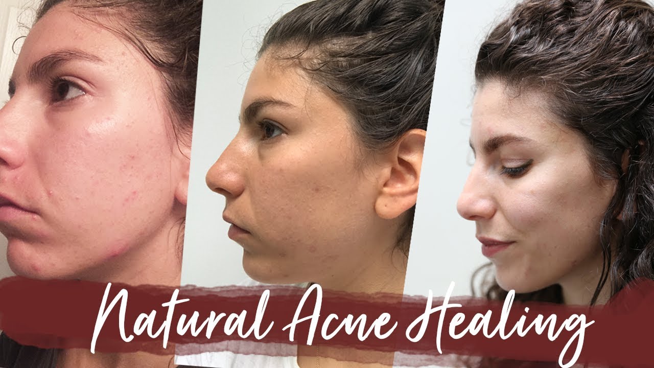 My ACNE-HEALING Skincare Routine - YouTube