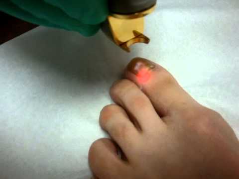 Toe nail fungus treatment with laser - YouTube