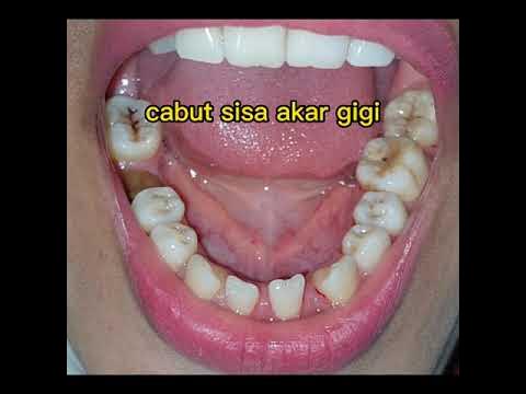 #cabutgigi #cabut cabut sisa akar gigi || drg heni - YouTube