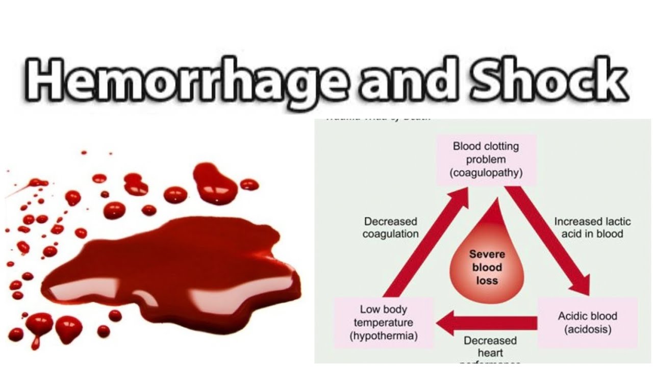 Hemorrhage & Shock 2 | Management + Definition, Pathophysiology ...