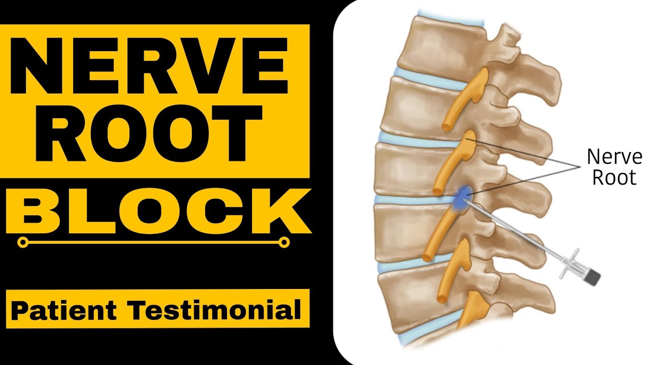 Nerve Root Block (Patient Testimonial) - YouTube
