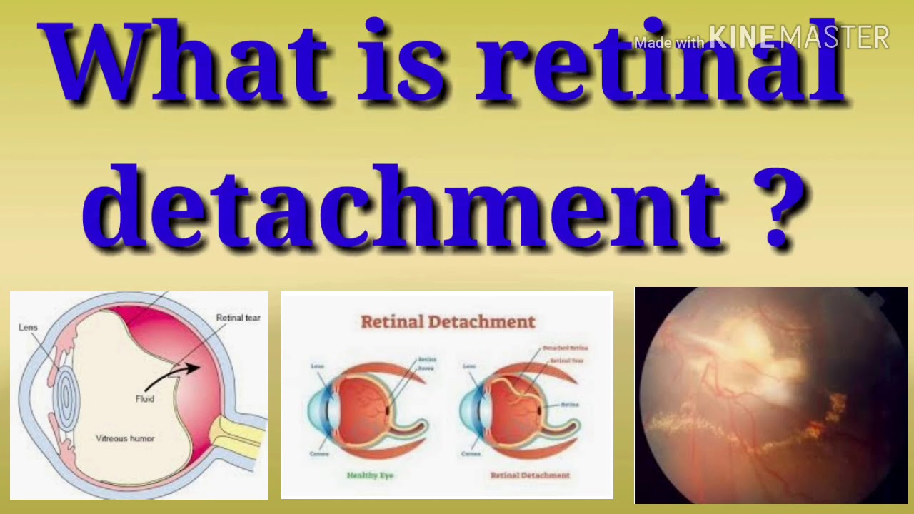 Retinal detachment || type of retinal detachment || Rhegmatogenous RD ...