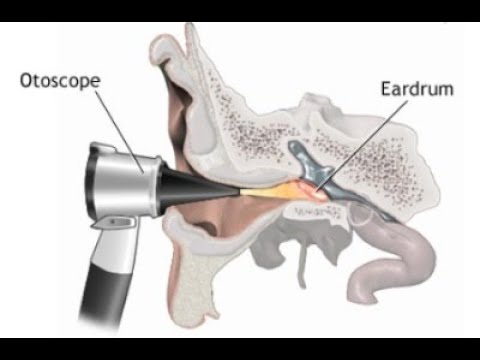 Physical Examination of the tympanic membrane; performed using an ...