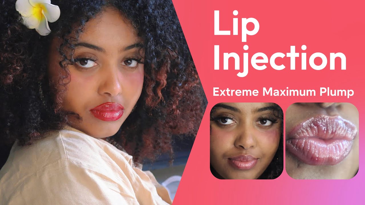 BBL lips ? 😭 maximum lip Injection plumper crazy results - YouTube