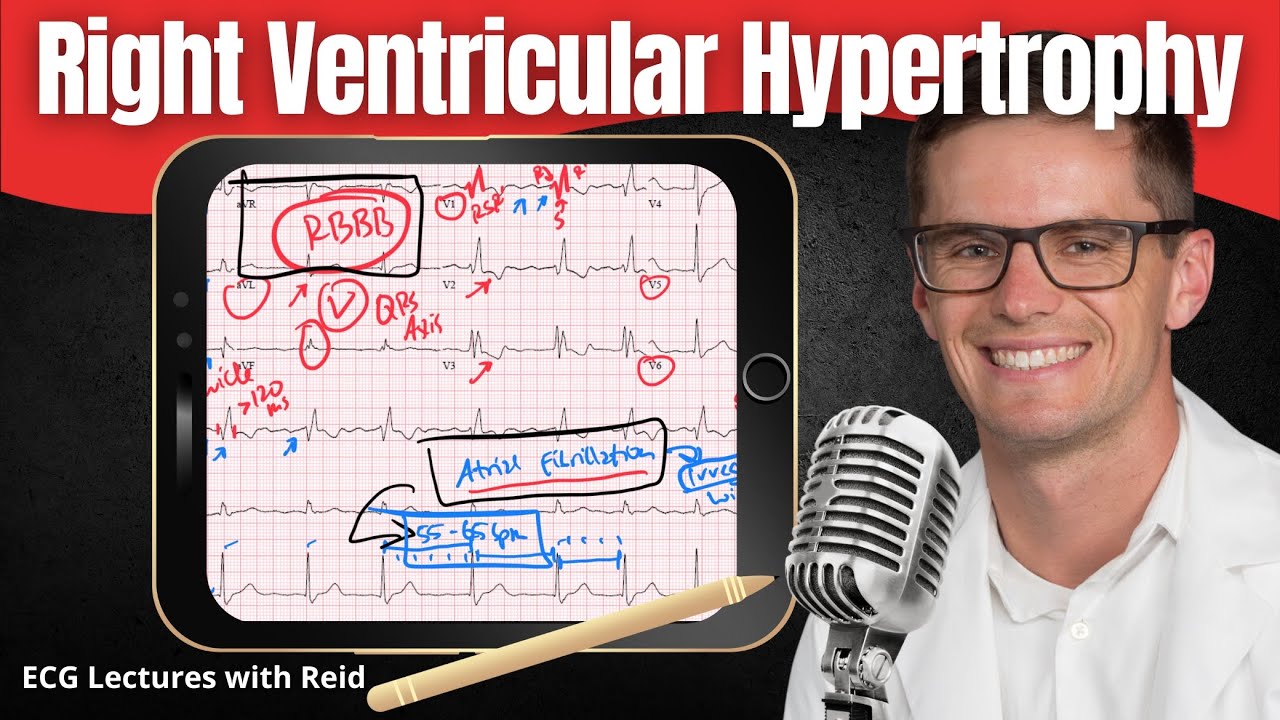 Right Ventricular Hypertrophy (RVH) EKG | ECG Lecture - YouTube