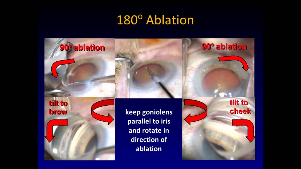 short key steps in trabectome surgery - YouTube