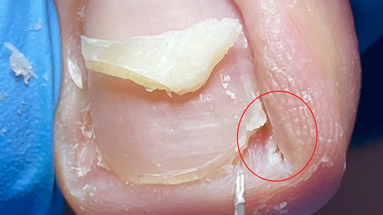 Cleaning up super long nails, nail crevices filled with dead skin - YouTube