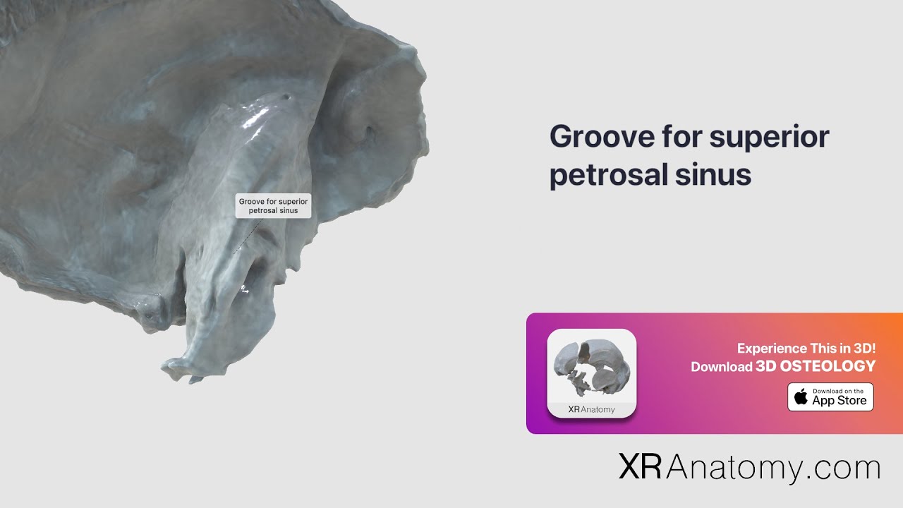 Temporal Bone - Groove for superior petrosal sinus - YouTube