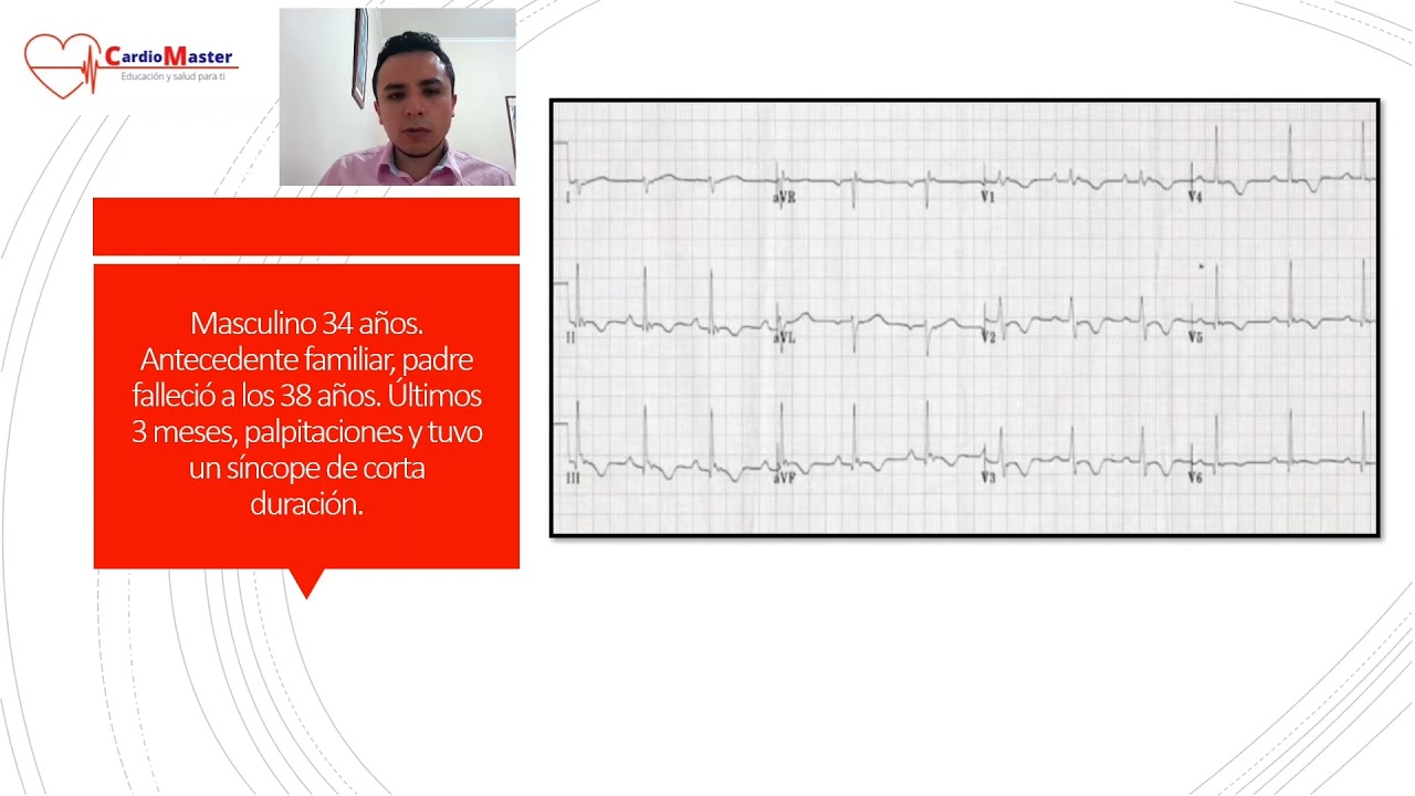 TRAZADOS DE ELECTROCARDIOGRAMA - EMERGENCIA - PARTE 2 - YouTube