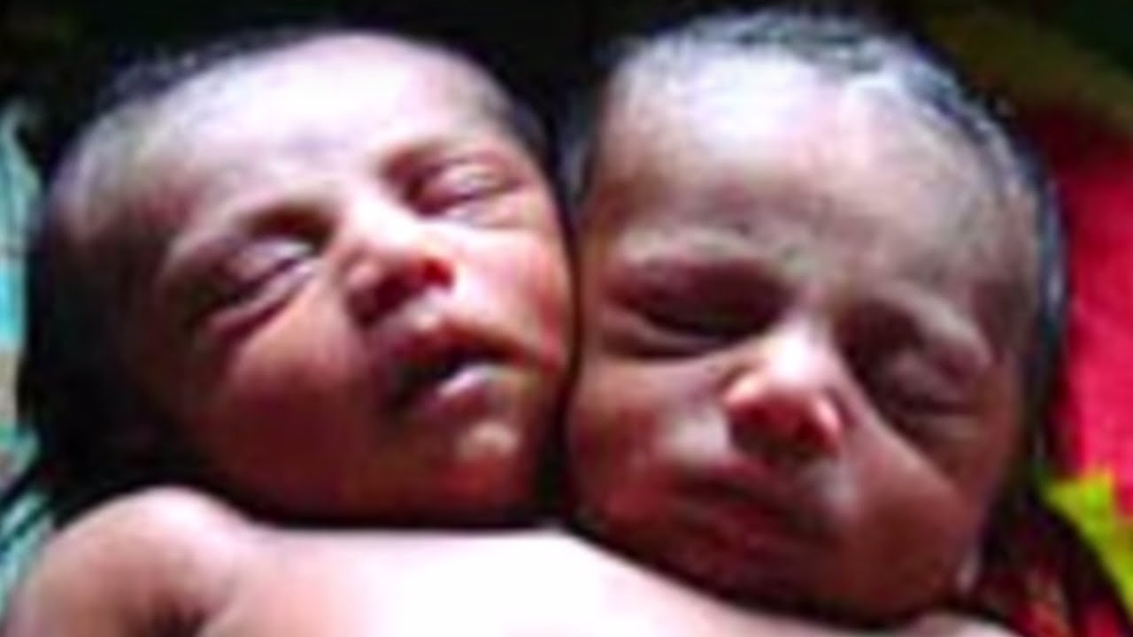 10 UNBELIEVABLE PEOPLE With Extra Body Parts - YouTube