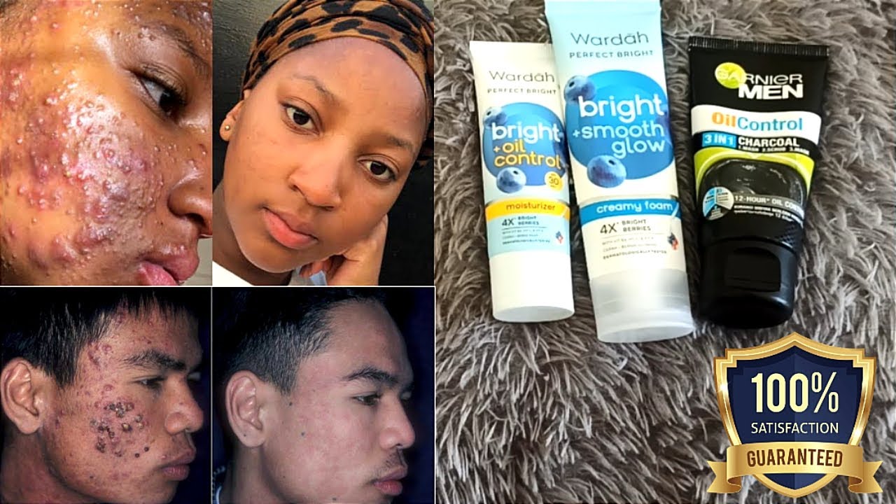 100% Working || Acne scars treatment || Pimples Solution || Acne ...