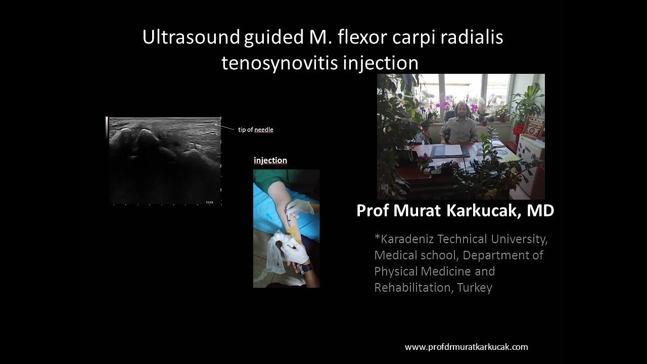 Ultrasound guided M. flexor carpi radialis tenosynovitis injection, by ...