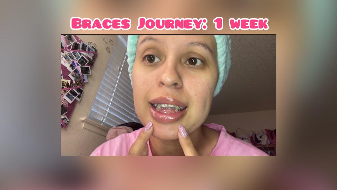 Braces Journey Update: One Week - YouTube