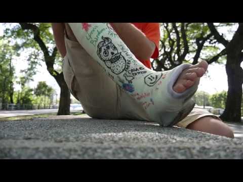 Plâtre - leg cast slwc - YouTube