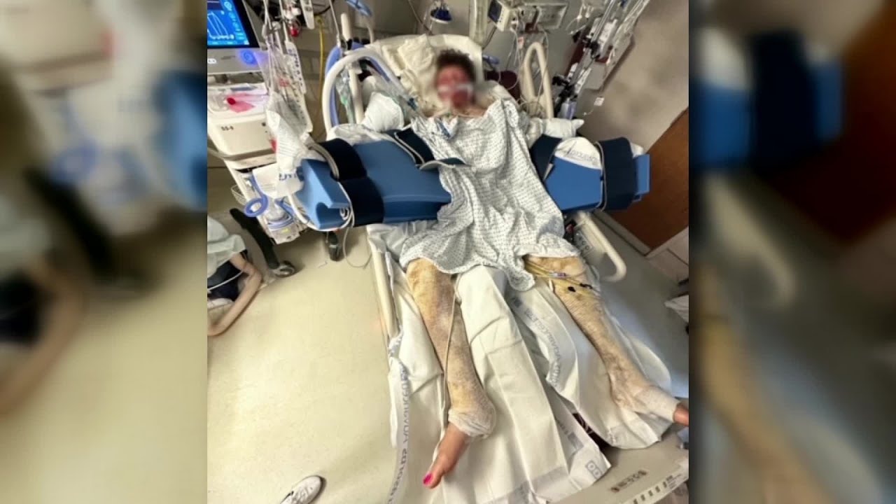 'A big boom:' TikTok challenge leaves Wake Forest teen with burns on ...