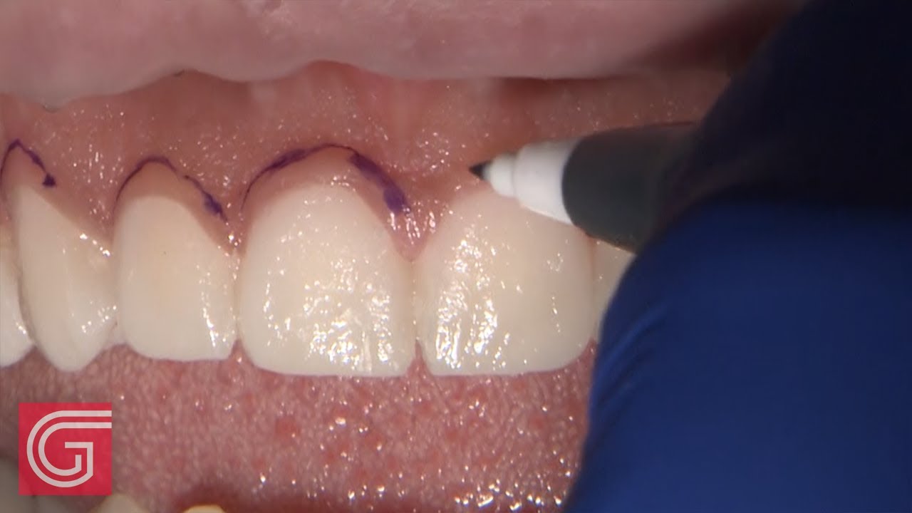 Creating ANTERIOR Mock-Up to Visualize an Ideal Gingival Display - YouTube