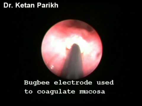 Endoscopic Fibrin glue treatment for Recurrent tracheo-esophageal ...