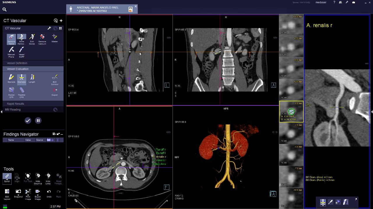 syngo.via CT Vascular - YouTube